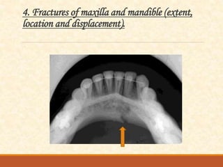Occlusal radiography | PPTX