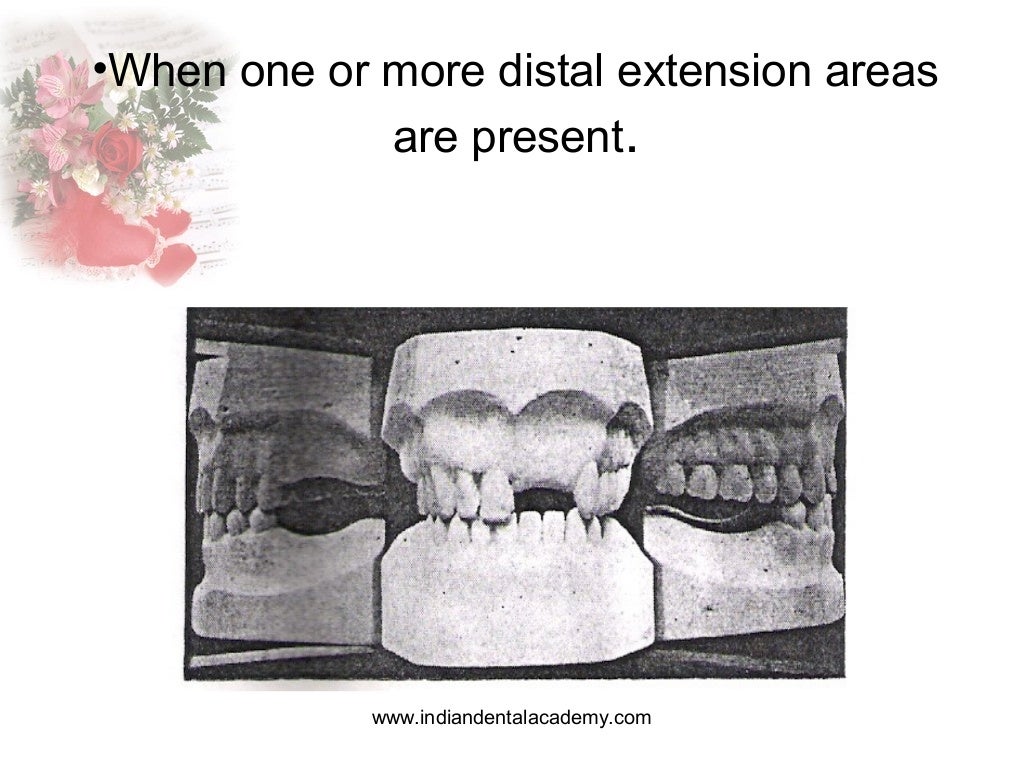 Occlusal registration in removable partial denture / orthodontic semi…
