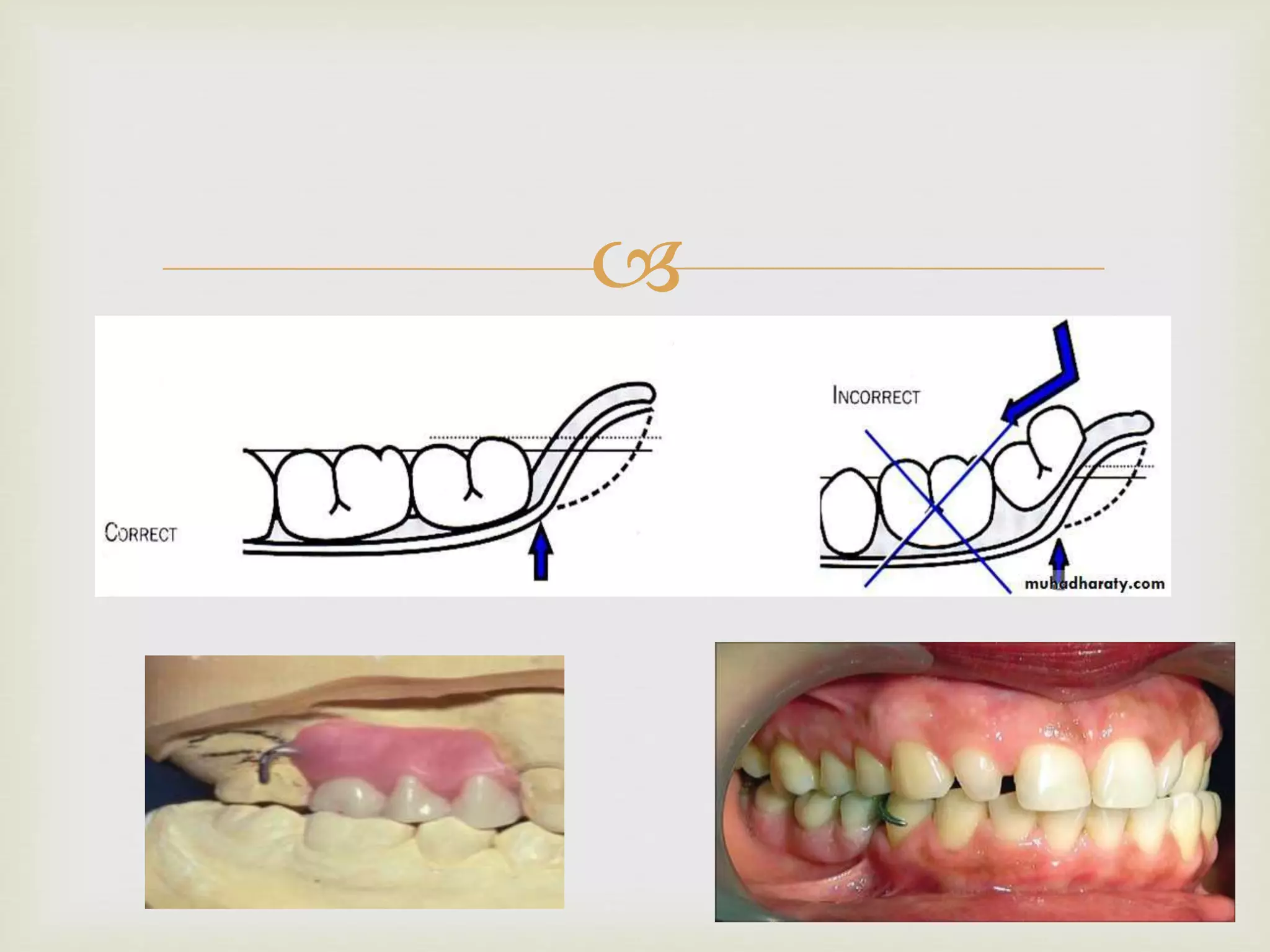 Occlusal relationship for removable partial denture | PPTX