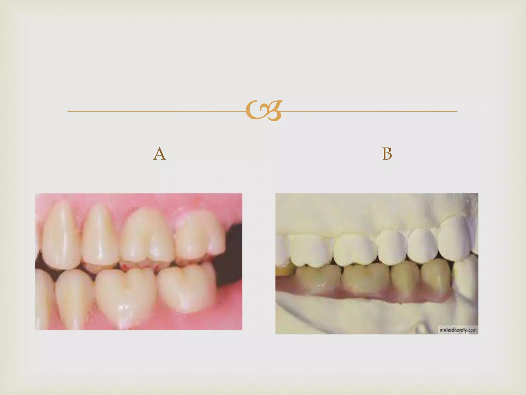 Occlusal relationship for removable partial denture | PPTX