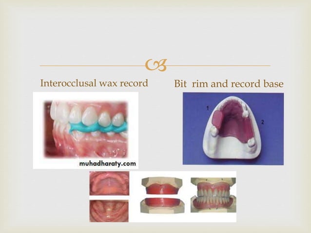 Occlusal relationship for removable partial denture | PPTX | Dental Health | Diseases and Conditions