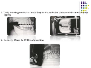 Occlusal relationship in_rpd__prostho_ | PPT