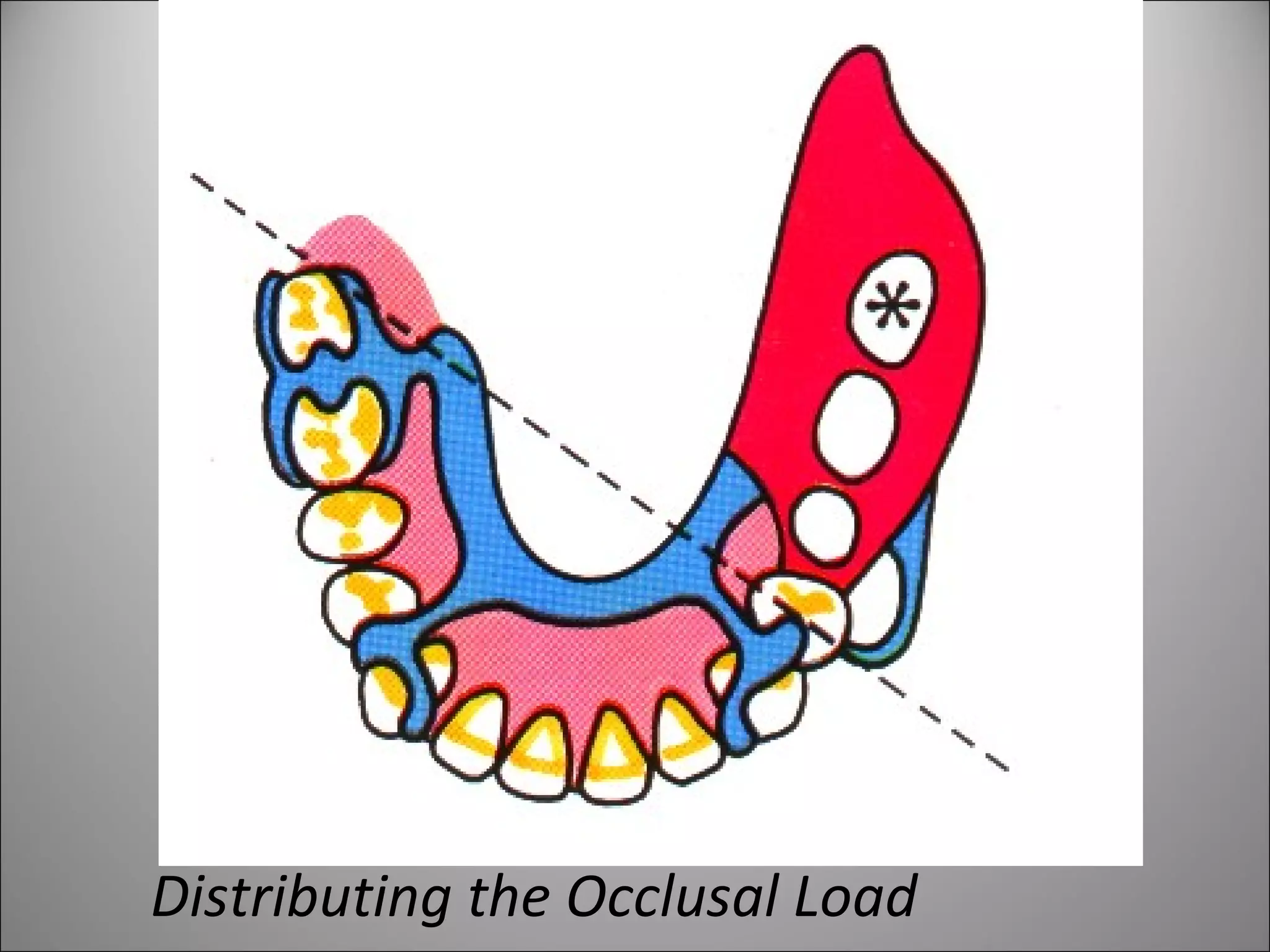 Occlusal rests | PPT