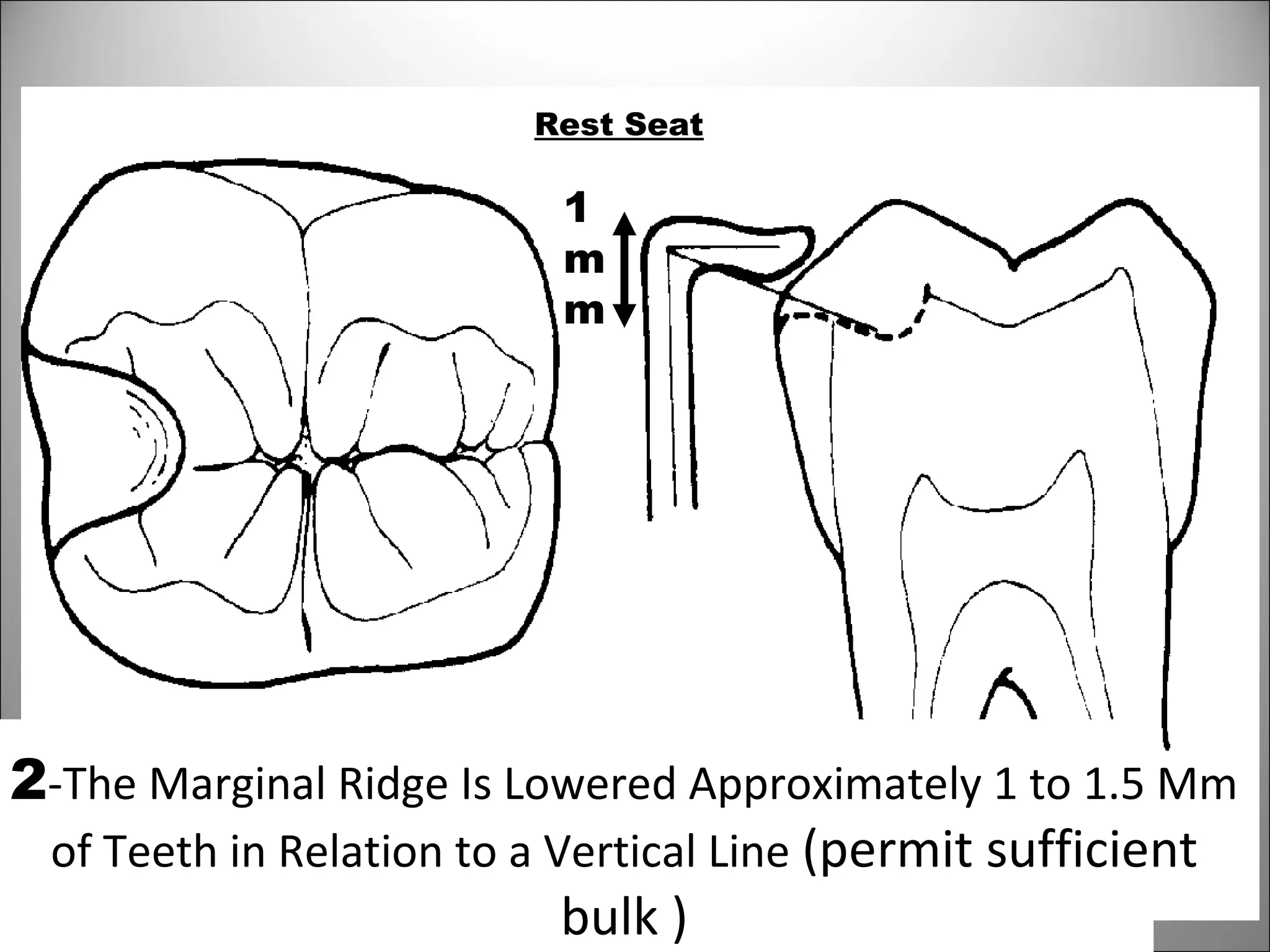 Occlusal rests | PPT