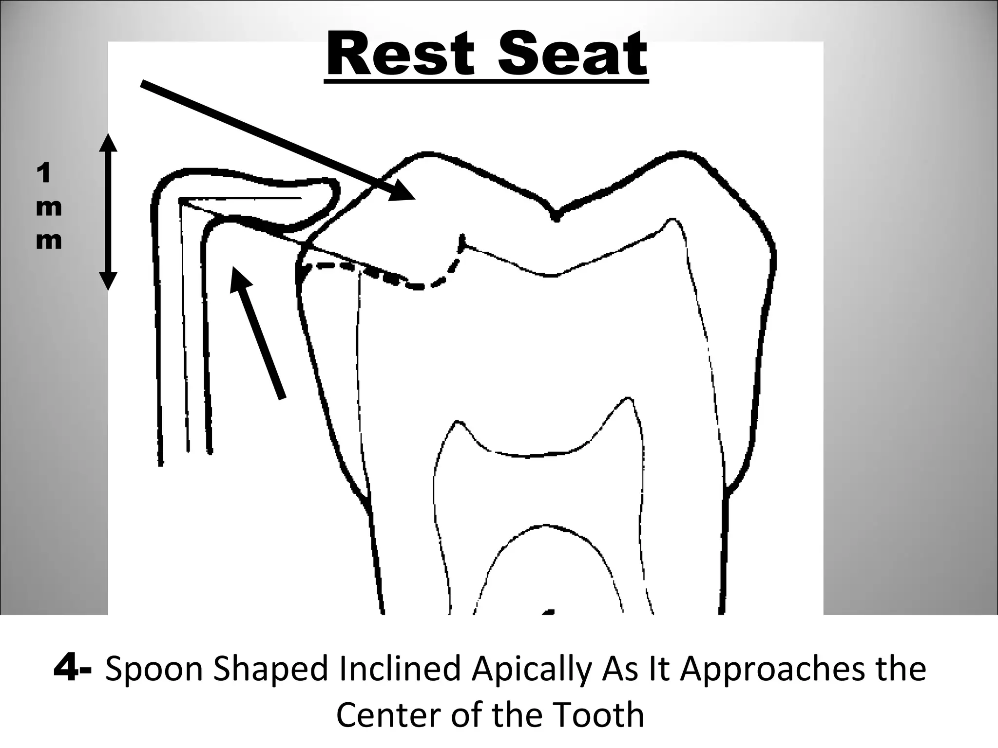 Occlusal rests | PPT