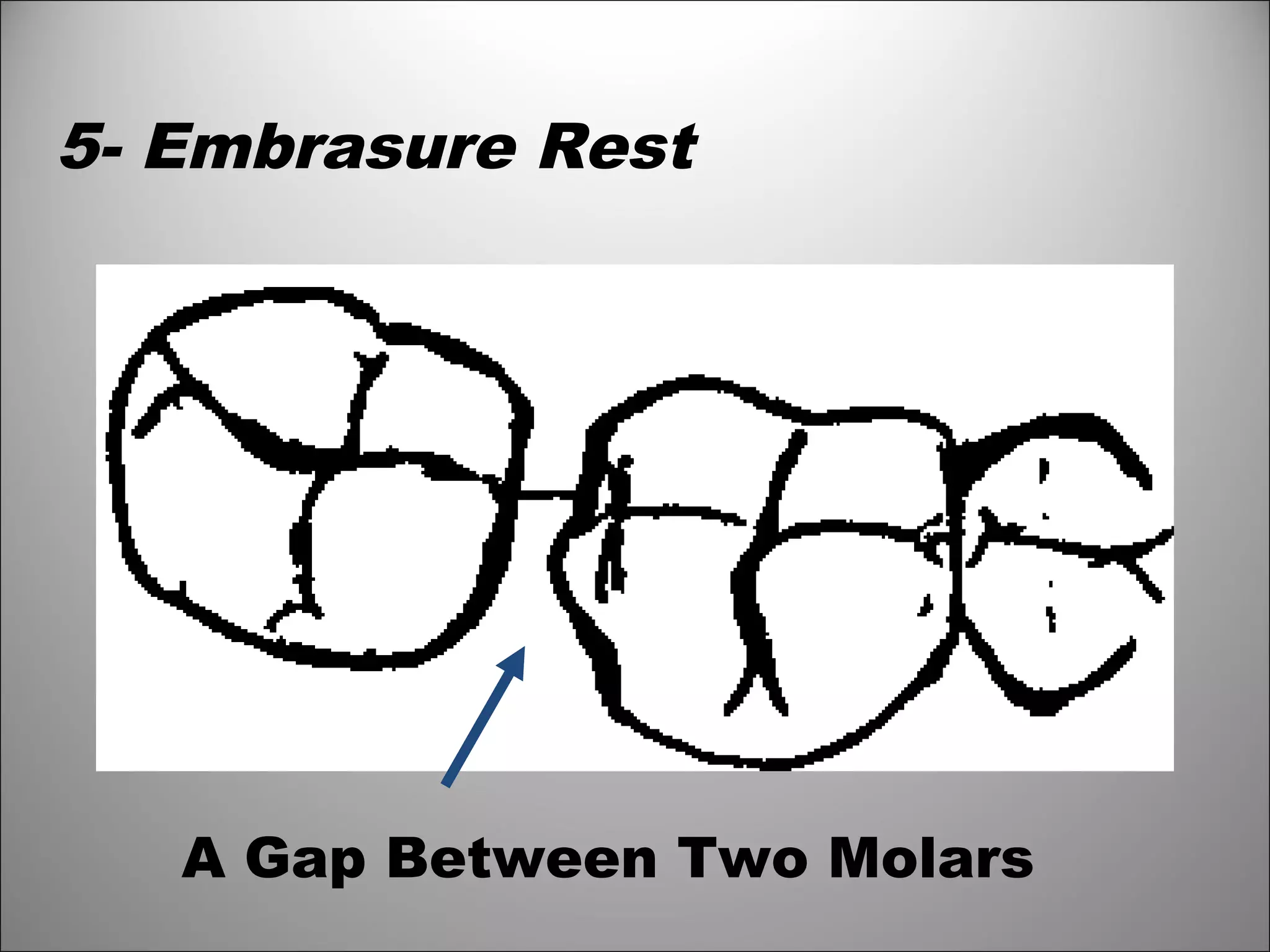 Occlusal rests | PPT