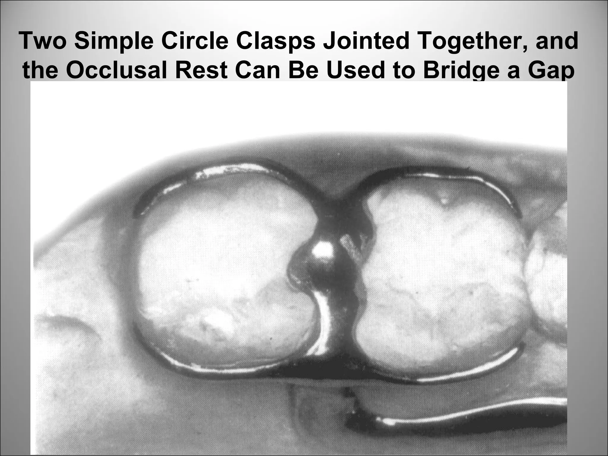 Occlusal rests | PPT