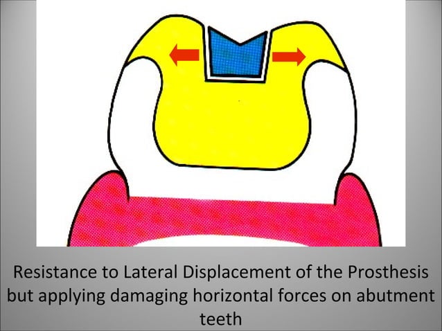 Occlusal rests | PPT | Dental Health | Diseases and Conditions