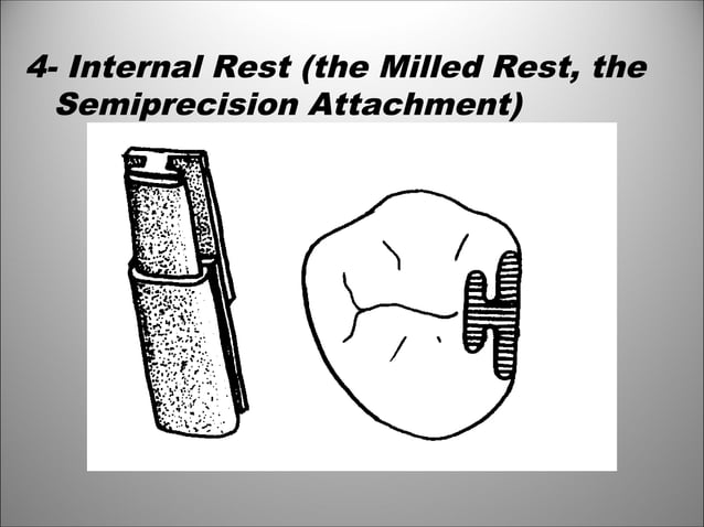 Occlusal rests | PPT | Dental Health | Diseases and Conditions