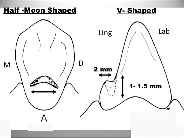 Occlusal rests