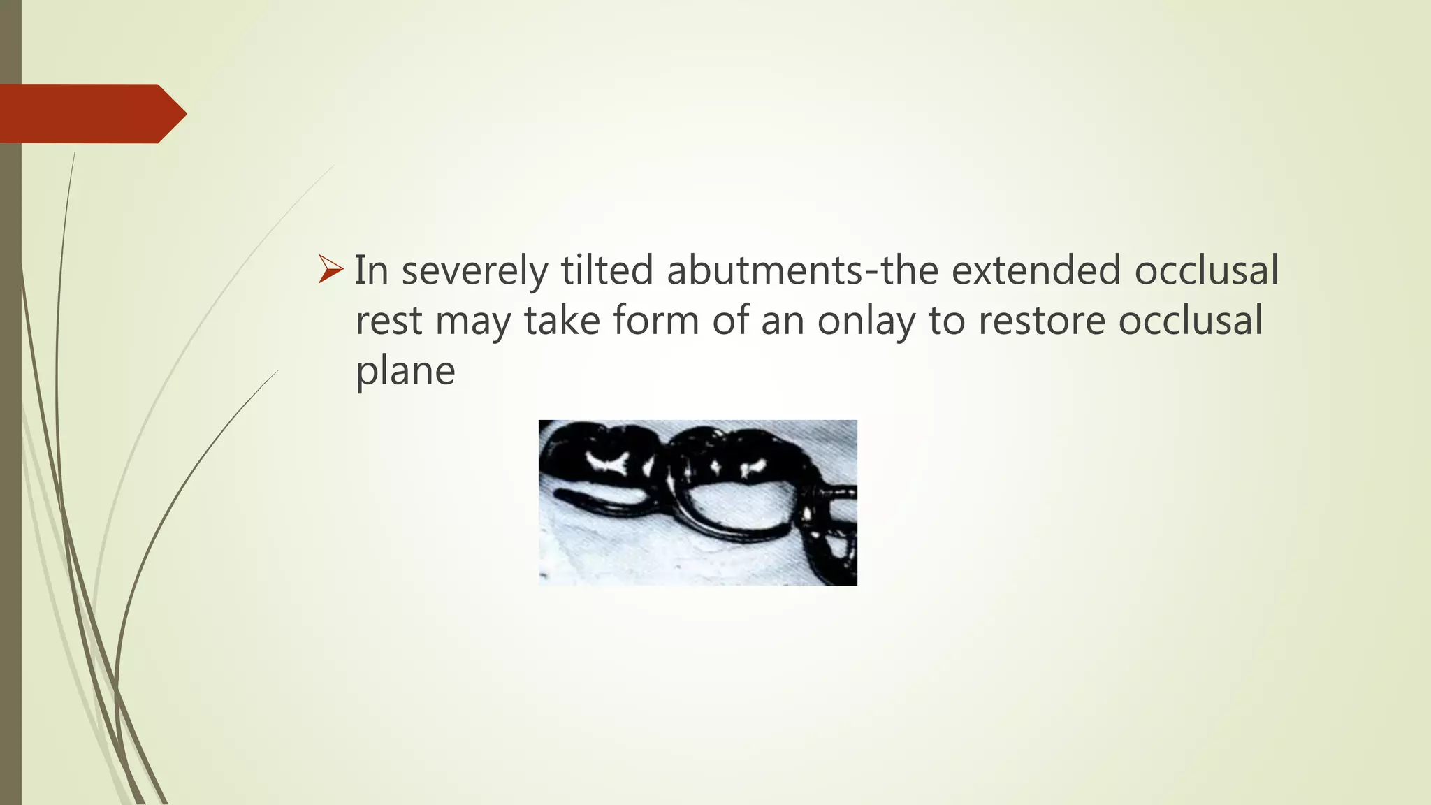 overview of occlusal rests and rest seats | PPTX