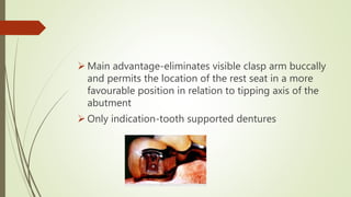 overview of occlusal rests and rest seats | PPTX