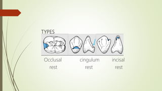 overview of occlusal rests and rest seats | PPTX
