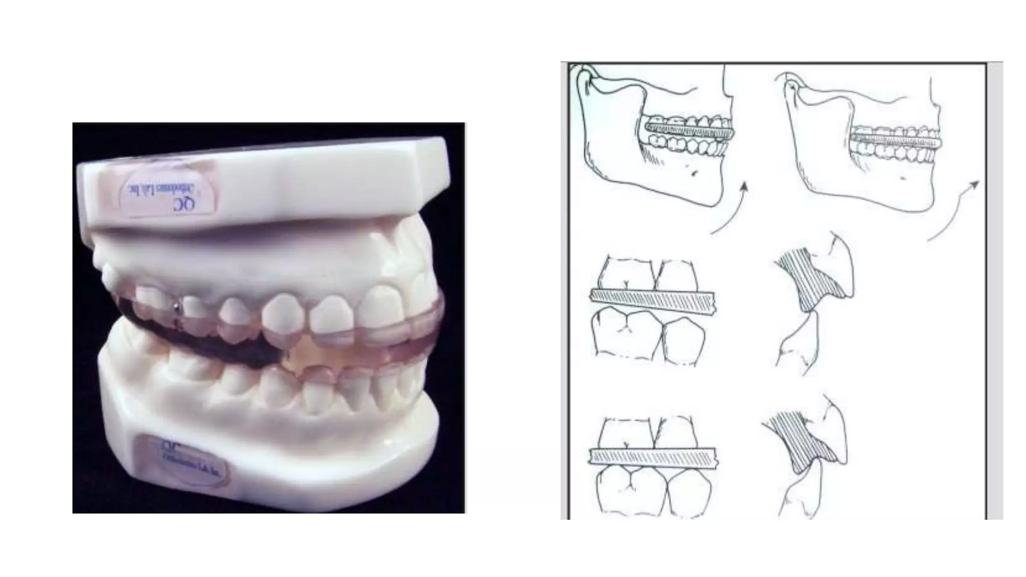 Occlusal splints | PPTX