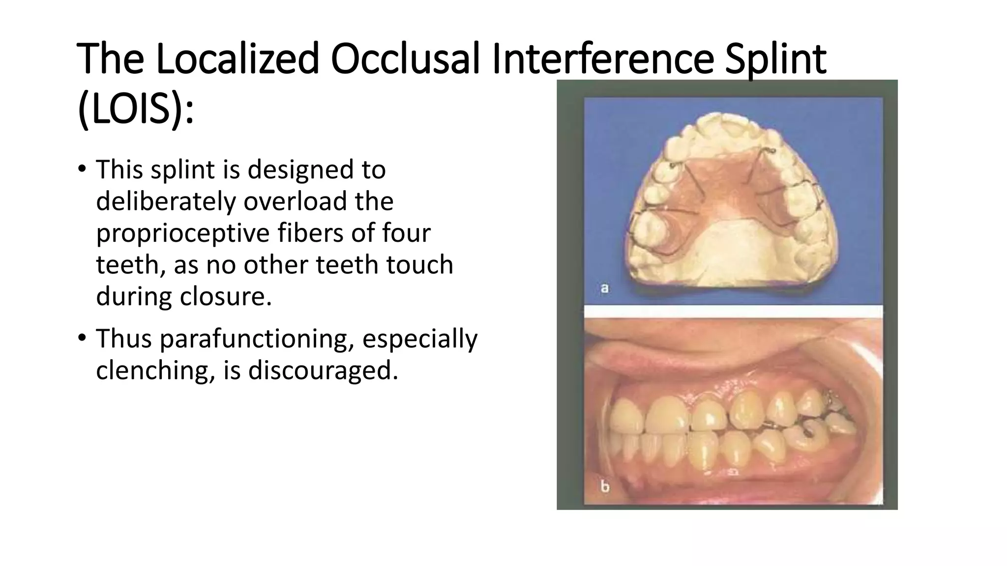 Occlusal splints | PPTX