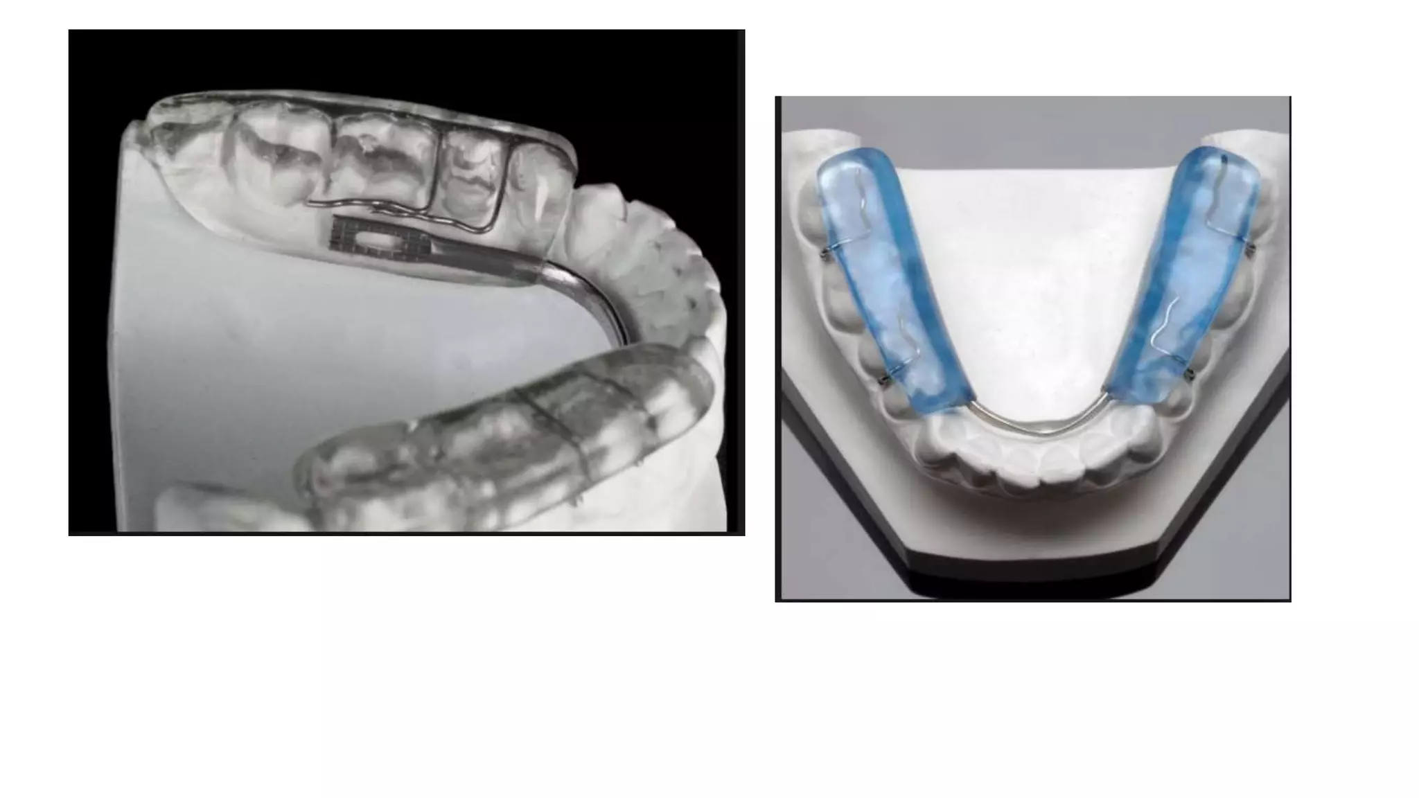 Occlusal splints | PPTX