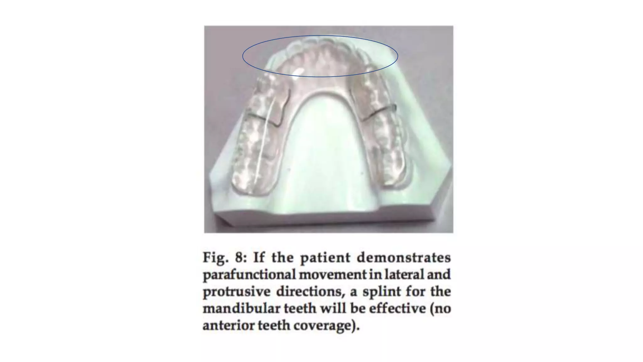 Occlusal splints | PPTX