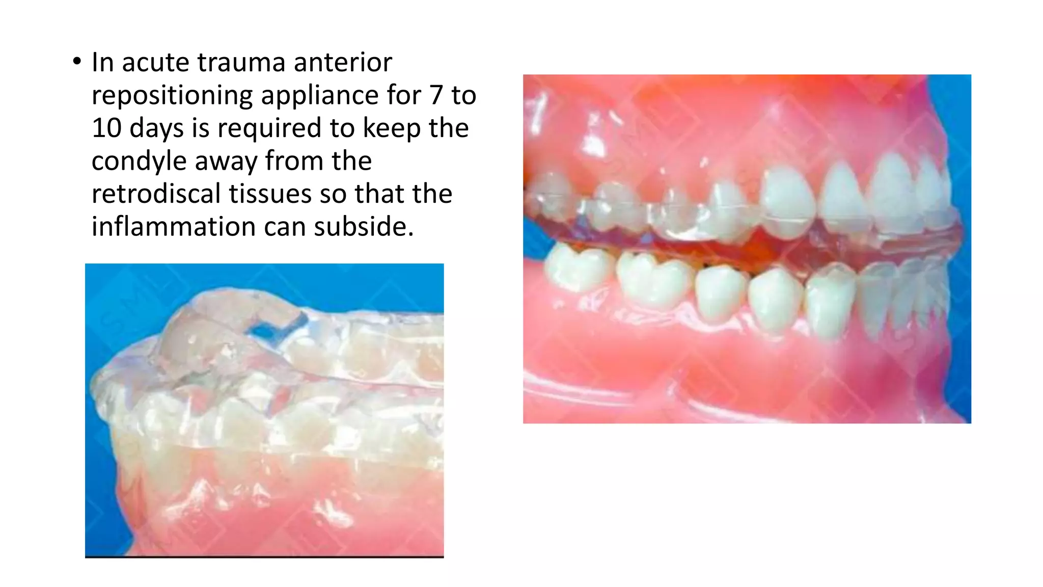 Occlusal splints | PPTX