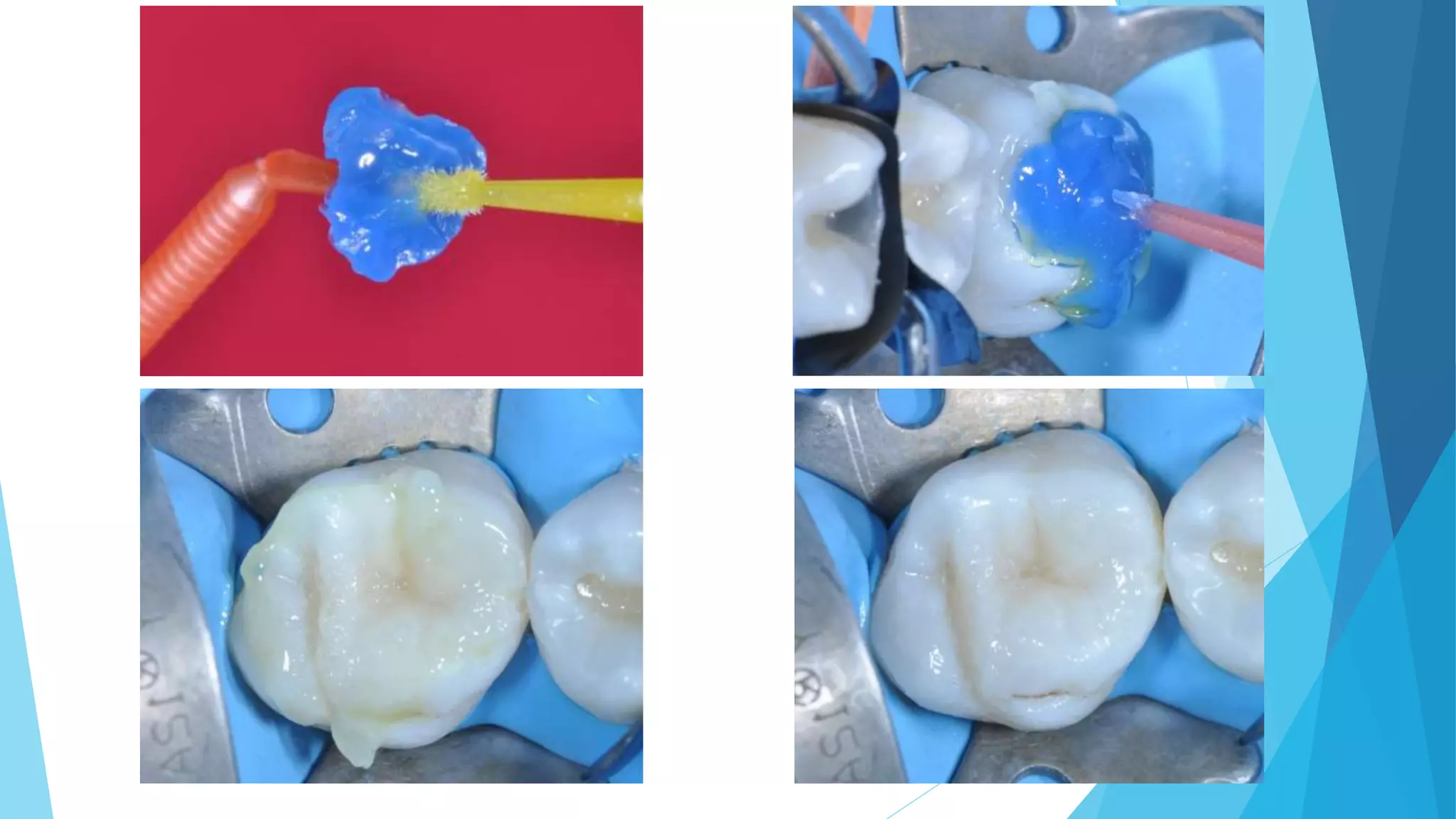 Occlusal stamp technique | PPTX