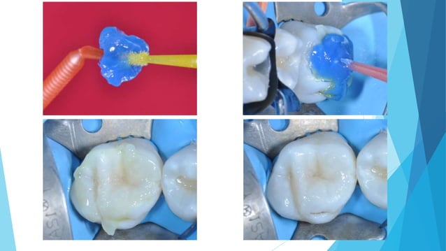Occlusal stamp technique | PPTX | Dental Health | Diseases and Conditions