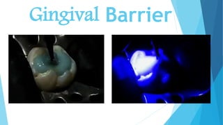 Occlusal stamp technique | PPTX