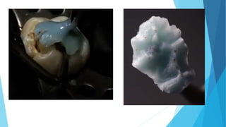 Occlusal stamp technique | PPTX