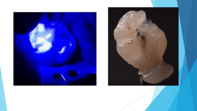 Occlusal stamp technique | PPTX | Dental Health | Diseases and Conditions