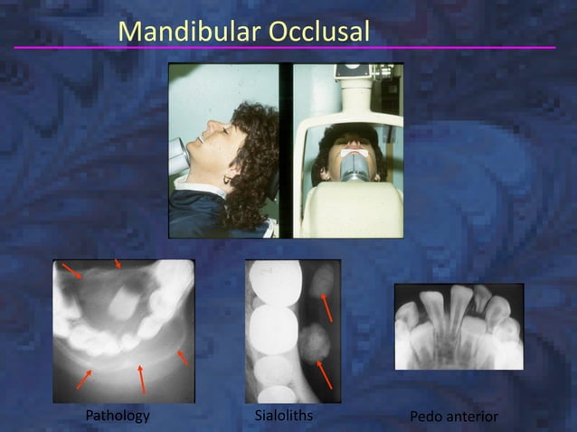Occlusal techniques | PDF | Dental Health | Diseases and Conditions