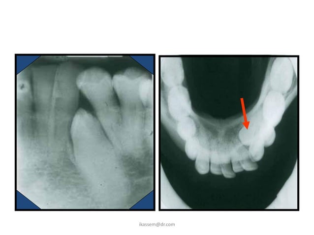 Occlusal techniques | PDF | Dental Health | Diseases and Conditions