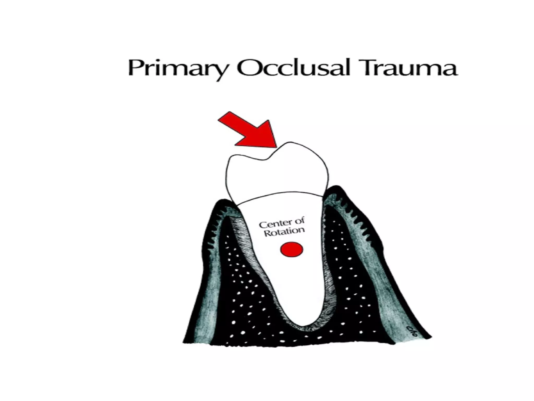 Occlusal trauma | PPT