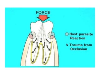 Occlusal trauma | PPT