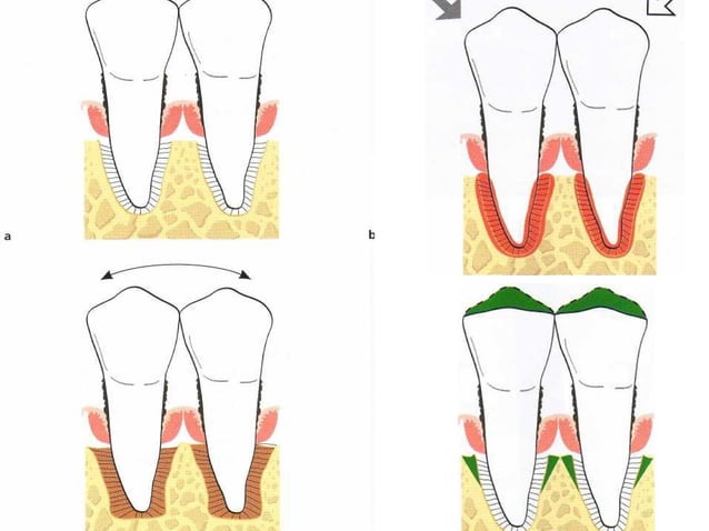Occlusal trauma | PPT