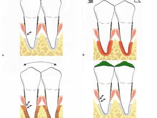 Occlusal trauma | PPT