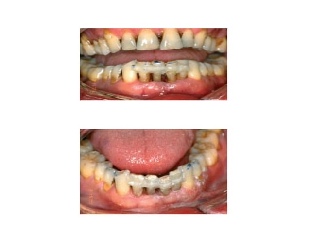 Occlusal trauma | PPT