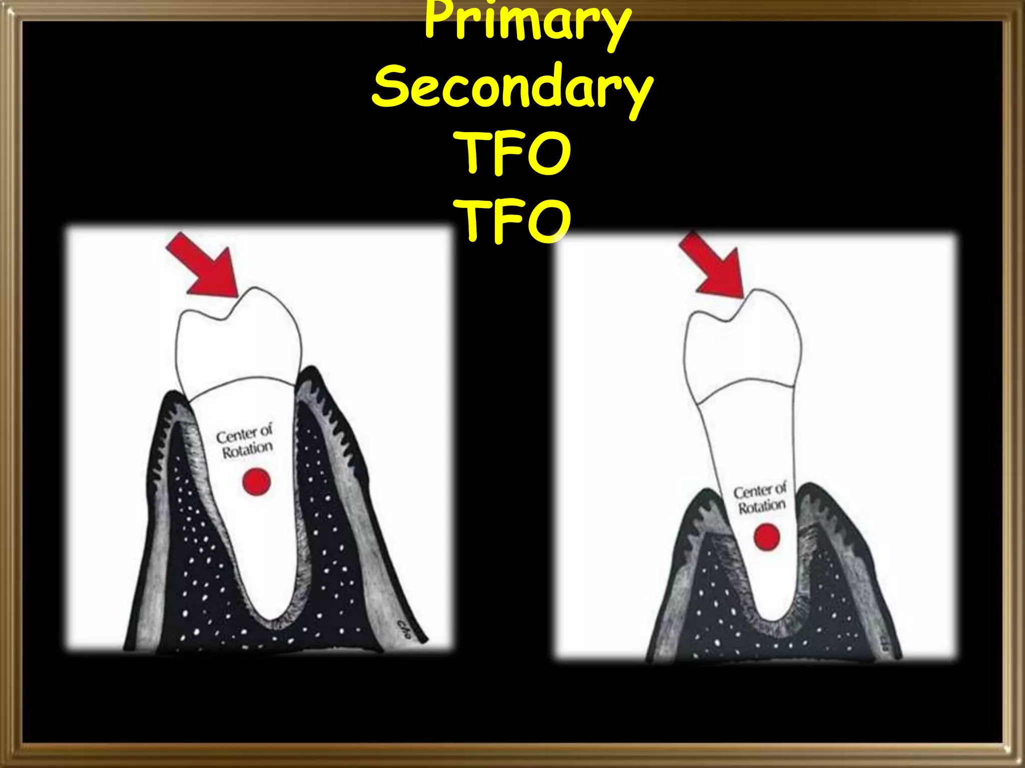 Occlusion in periodontal practice - Dr Harshavardhan Patwal | PPTX