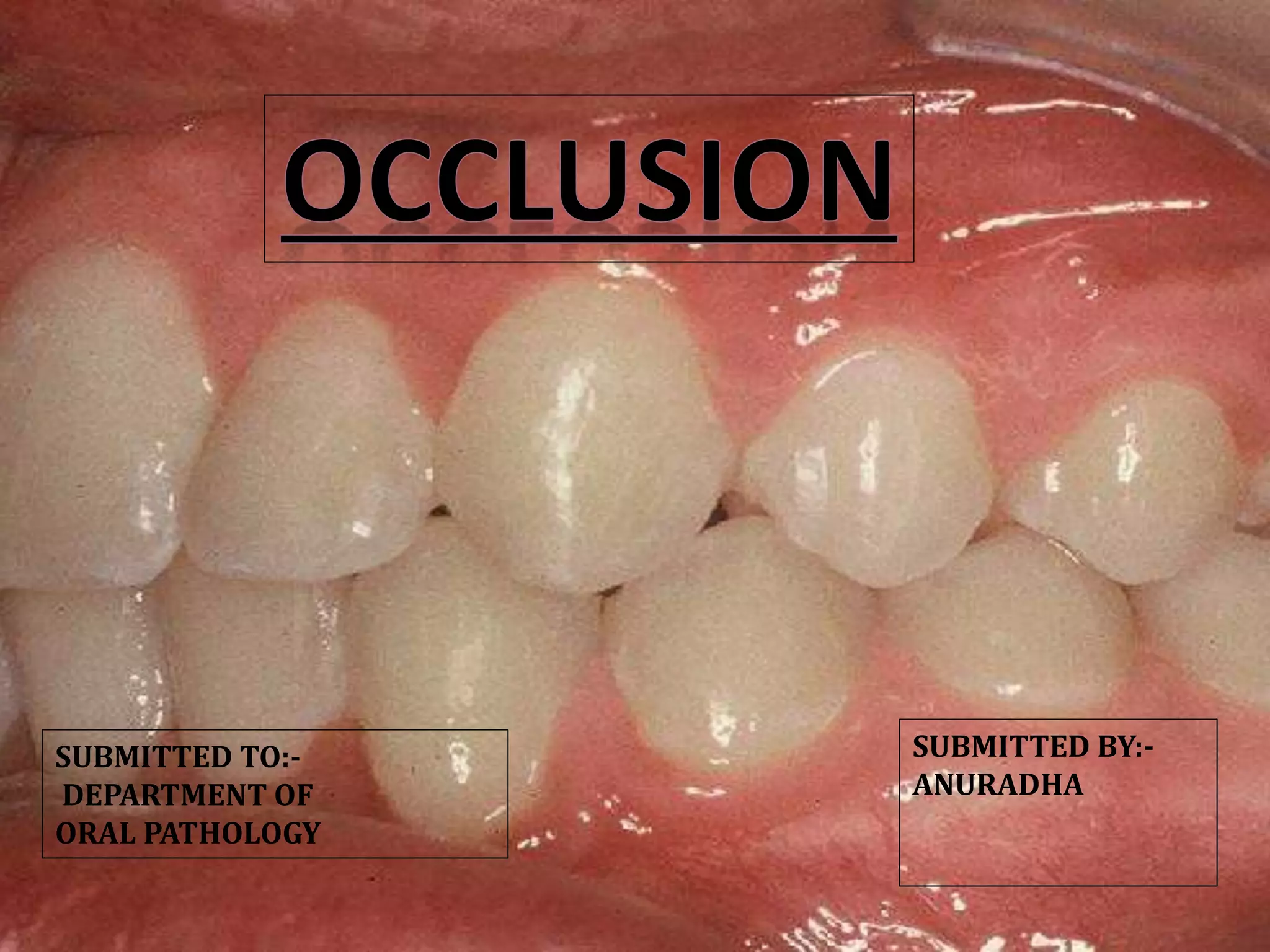 Occlusion | PPTX