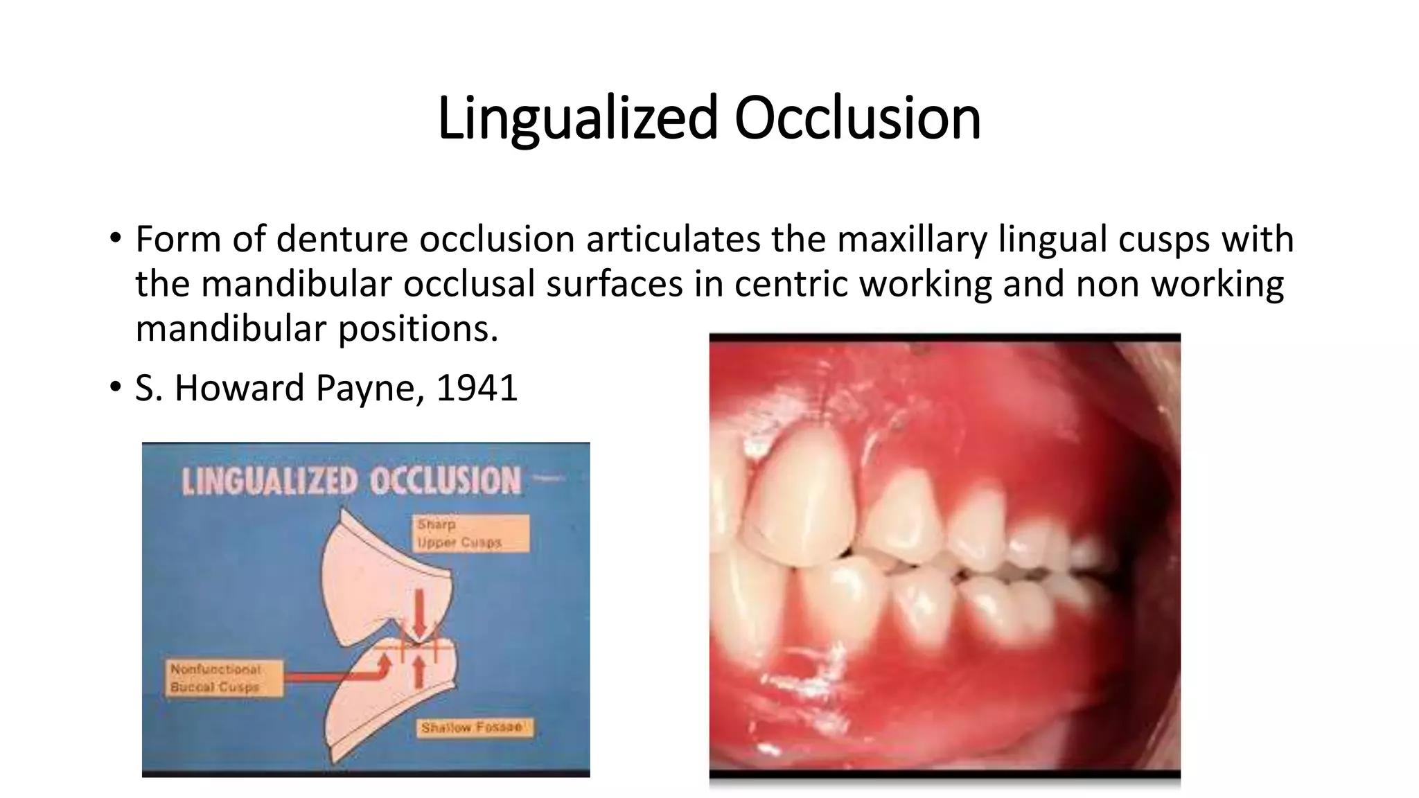 Occlusion in Complete denture | PPTX