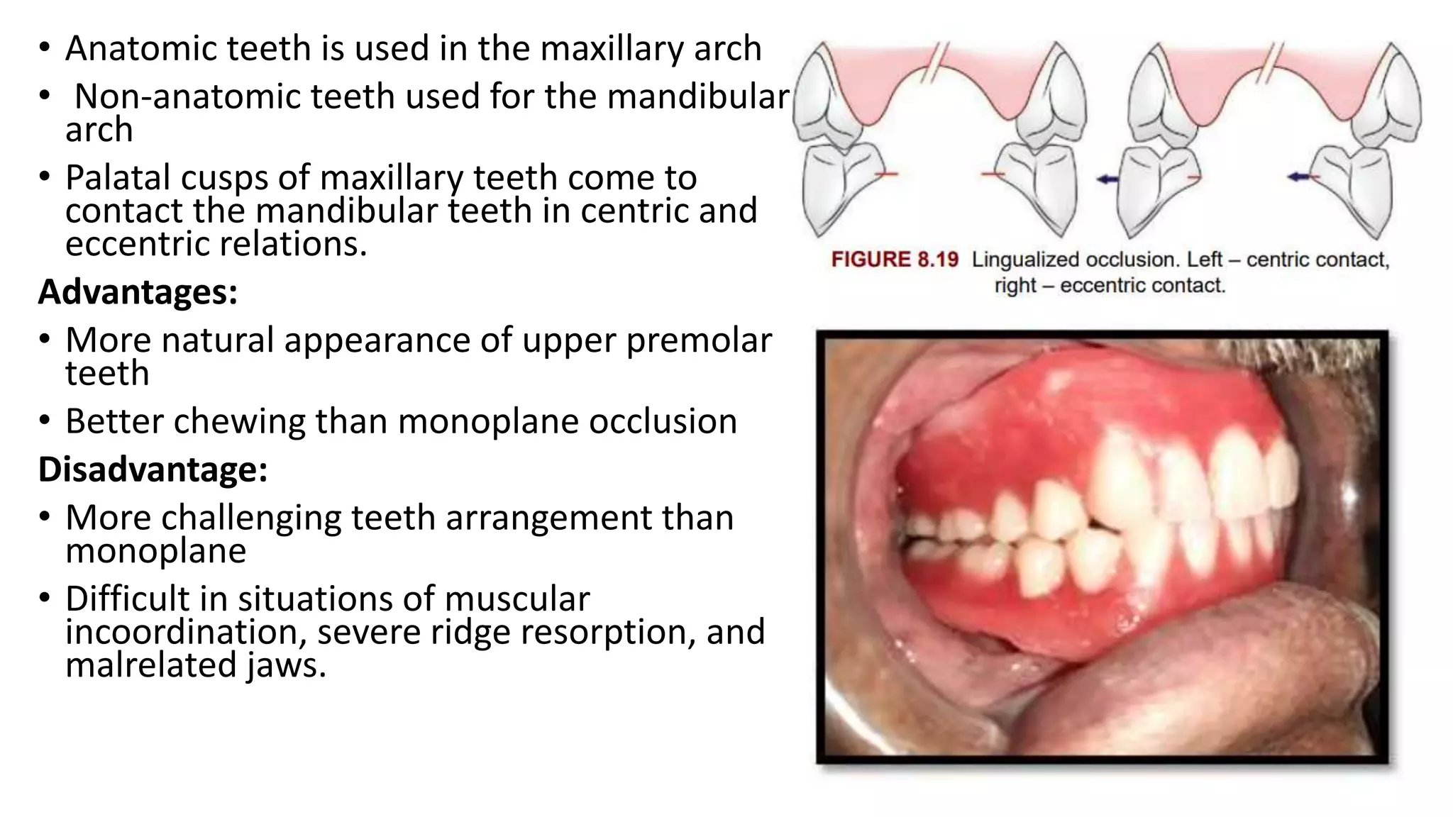 Occlusion in Complete denture | PPTX