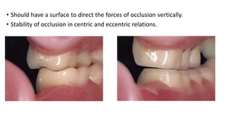 Occlusion in Complete denture | PPTX
