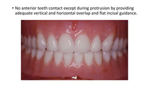 Occlusion in Complete denture | PPTX