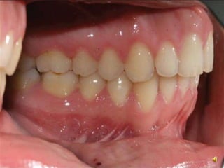 Occlusion and it's types and malocclusion | PPTX