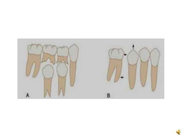 Occlusion and it's types and malocclusion | PPTX
