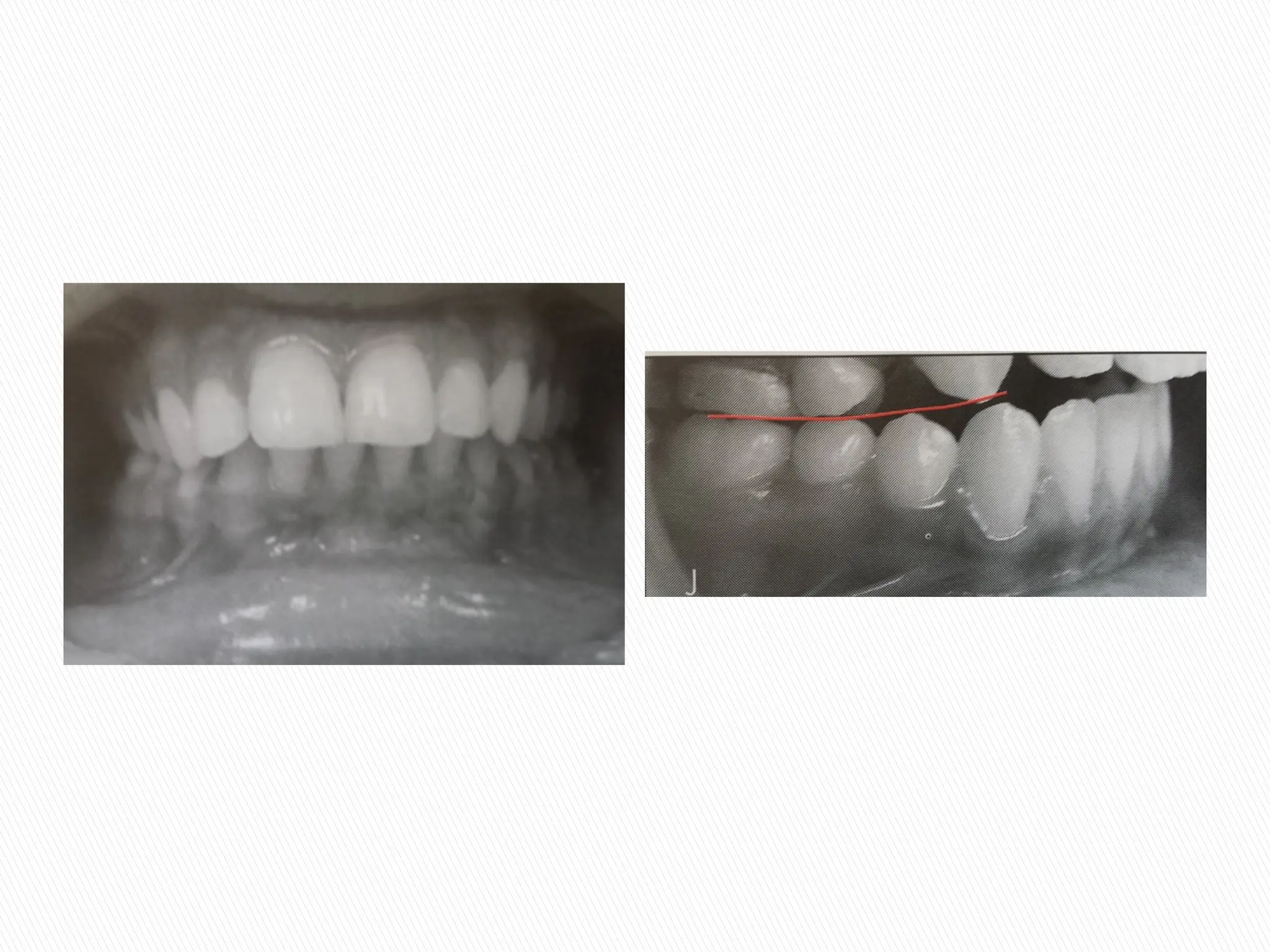 OCCLUSION- Occlusion is a complex phenomenon involving the teeth ...