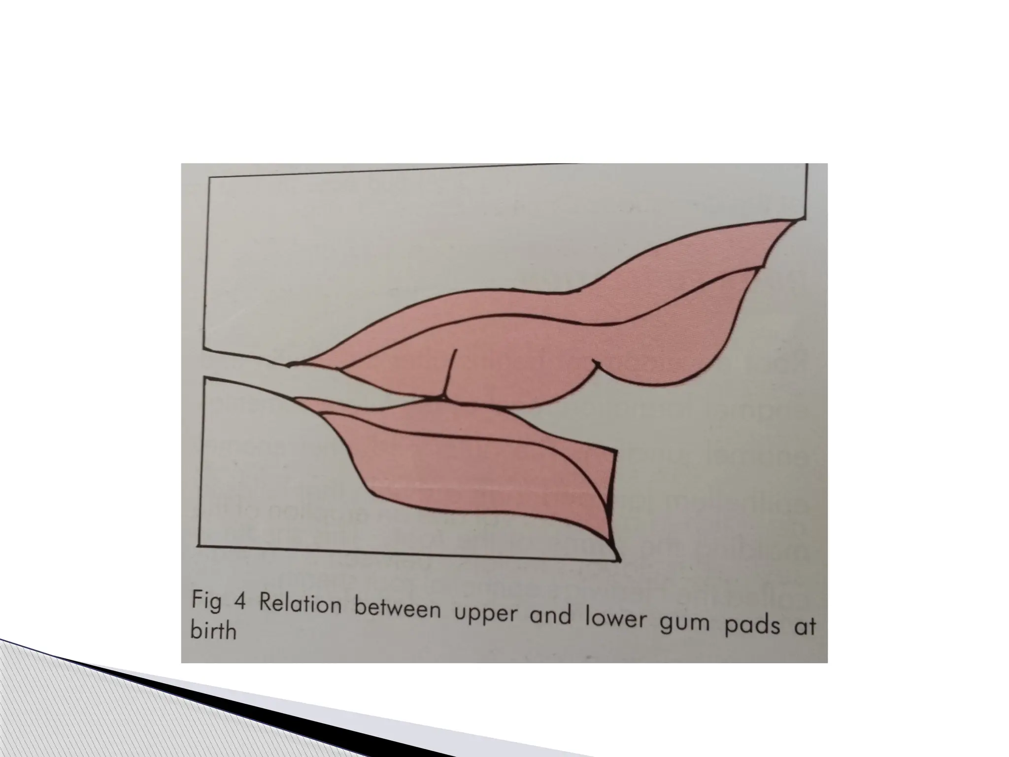 OCCLUSION- Occlusion is a complex phenomenon involving the teeth ...