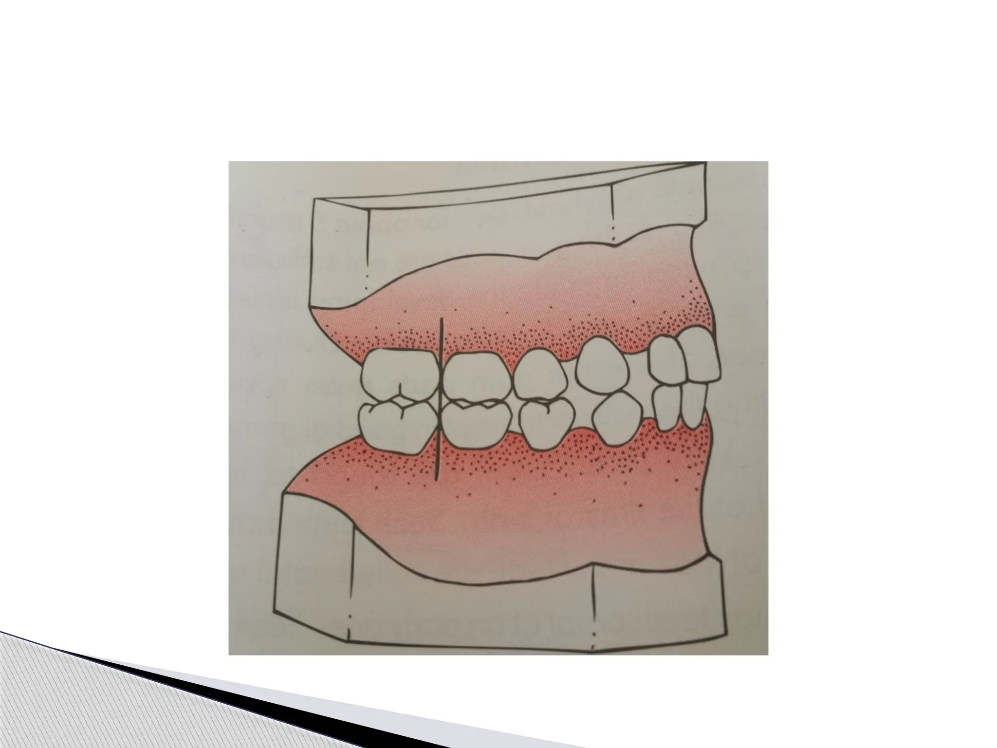 OCCLUSION- Occlusion is a complex phenomenon involving the teeth ...