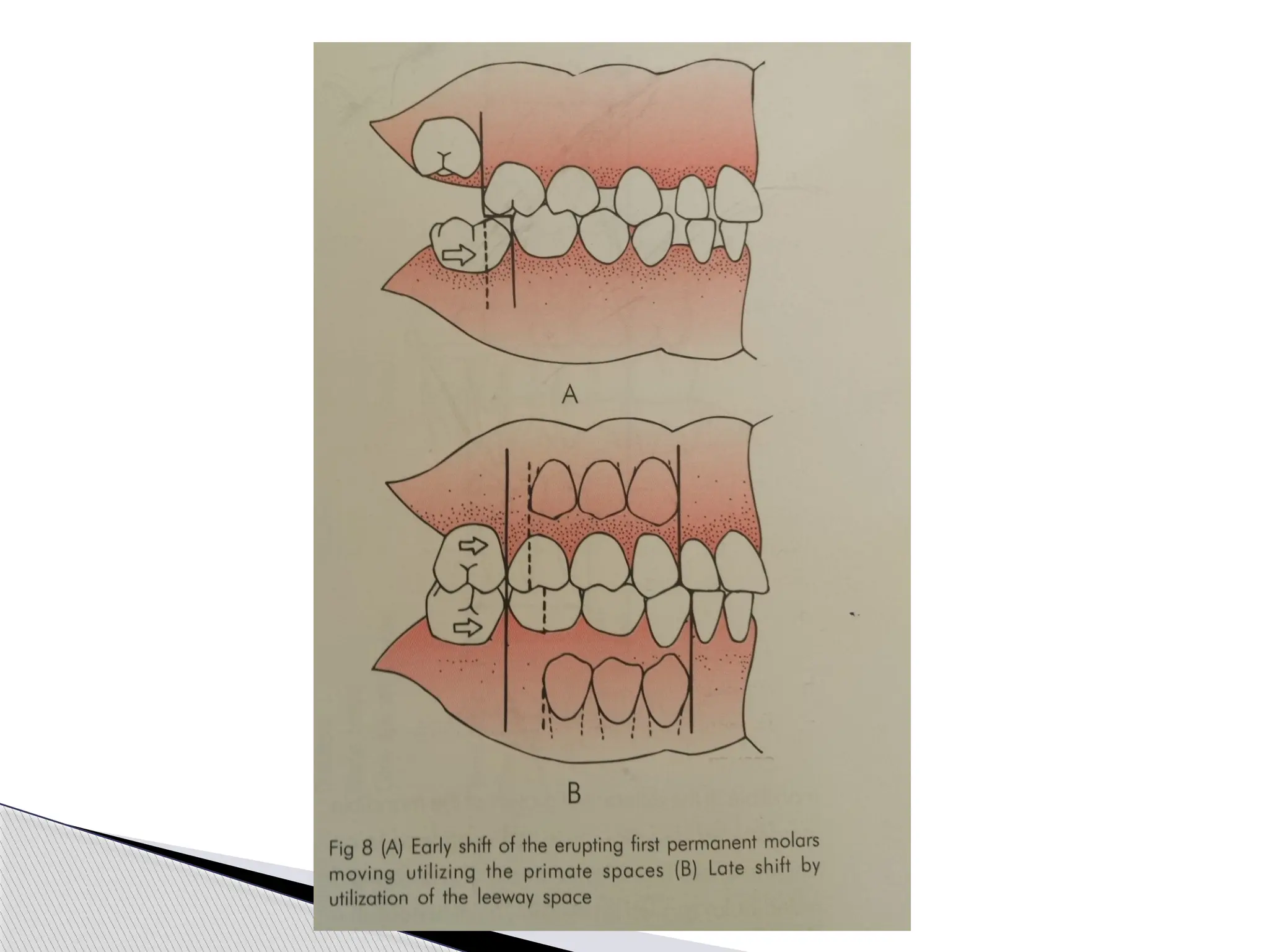 OCCLUSION- Occlusion is a complex phenomenon involving the teeth ...
