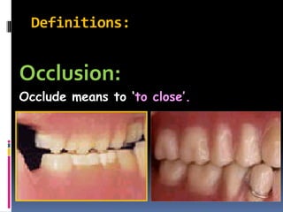 Occlusion in complete denture basic concept | PDF
