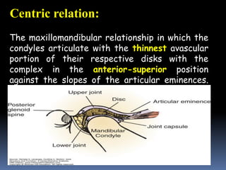 Occlusion in complete denture basic concept | PDF