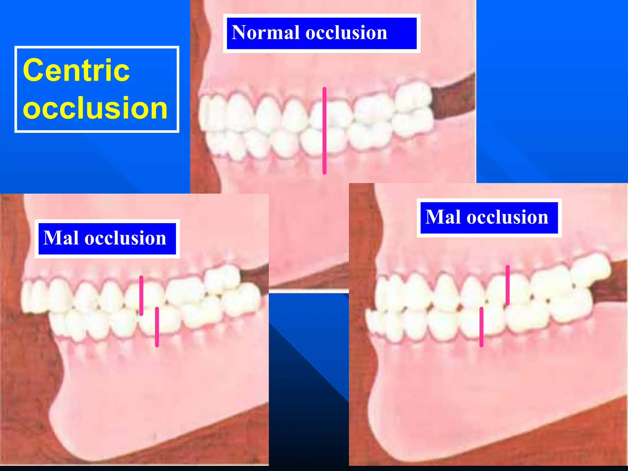 Occlusion1 Dr. Reham 6OU 2024 (1) pdf... | PPT