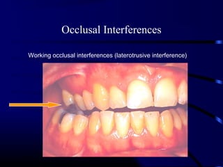 Occlusion2 | PPT | Dental Health | Diseases and Conditions